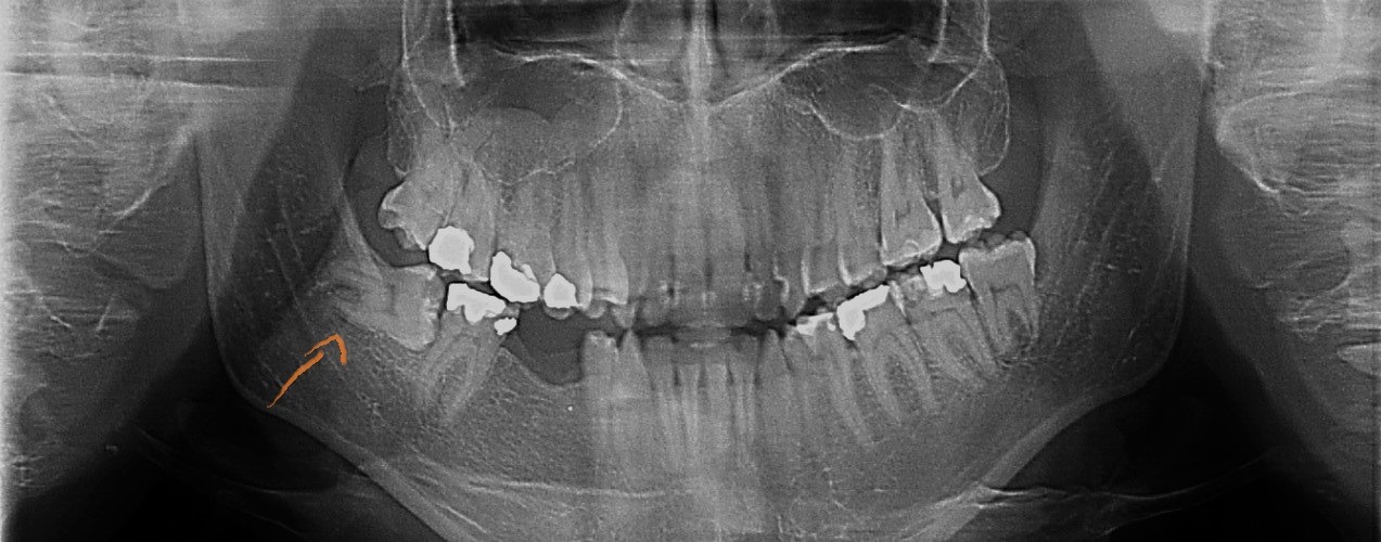 RTG zębów – kiedy oraz dlaczego się je wykonuje | Microestetic